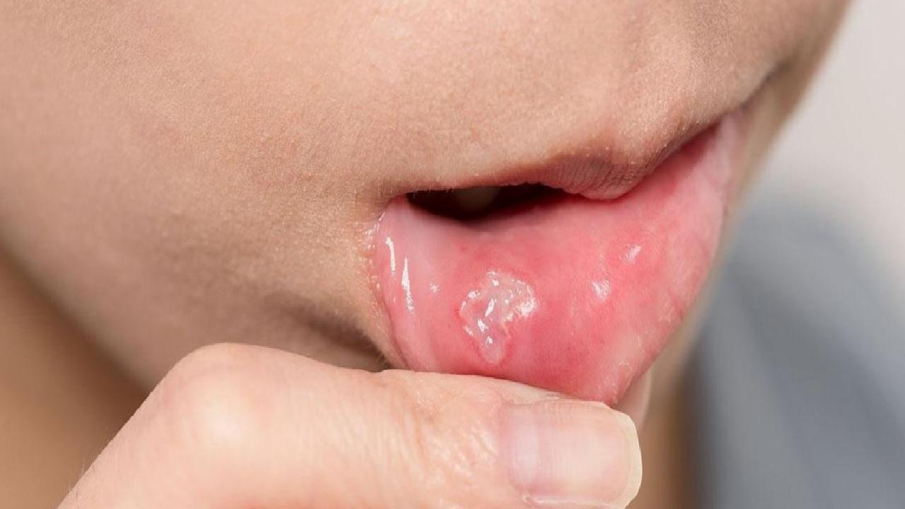 Uçuk Nedir ve Tedavisi