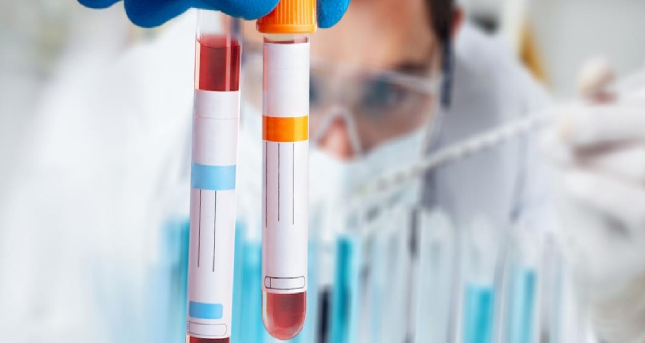 Basit Kan Testi ile Kalp Hastalığı Riski Belirleniyor